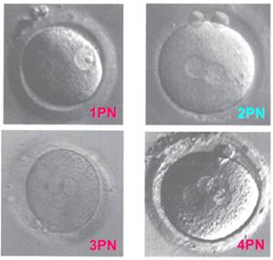 卵子异常受精的梦魇__凤凰网