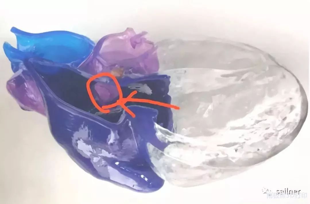 3D打印心脏模型+5G网络！广东高州人民医院成功实施远程“补心术”__凤凰网