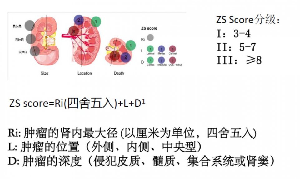 肾癌保肾手术的评估和要点__凤凰网