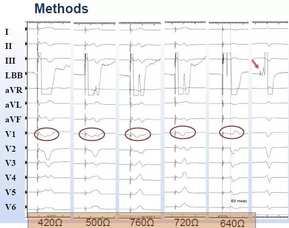 HRS2019丨吴永全/张俊蒙报道：起搏新方法，左束支区域起搏安全可行__凤凰网
